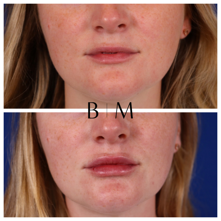 Dermal Fillers In Manhattan | Facial Fillers In New York City